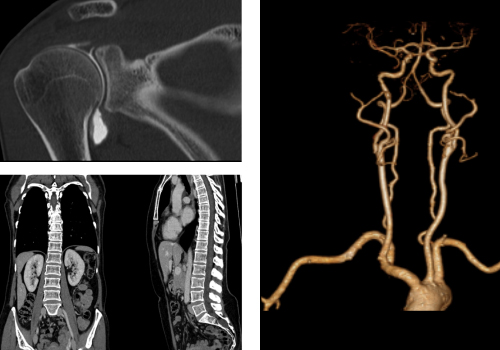 Scanner/Arthroscanner – IMREP – Clermont-ferrand – Image Médicale ...